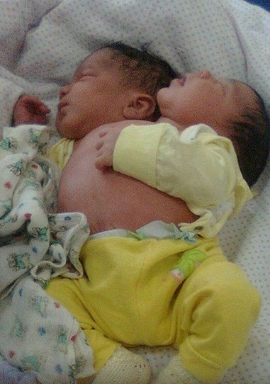 Two Headed Babies